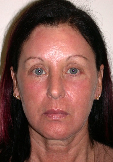 Before and after photos of cosmetic surgery by Dr BCK Patel in Salt ...