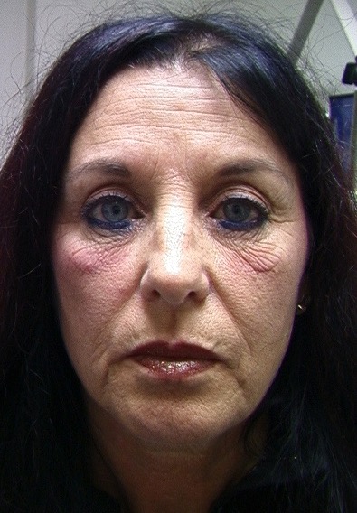 Before and after photos of cosmetic surgery by Dr BCK Patel in Salt ...