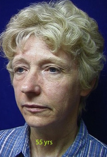 Before and after photos of cosmetic surgery by Dr BCK Patel in Salt ...